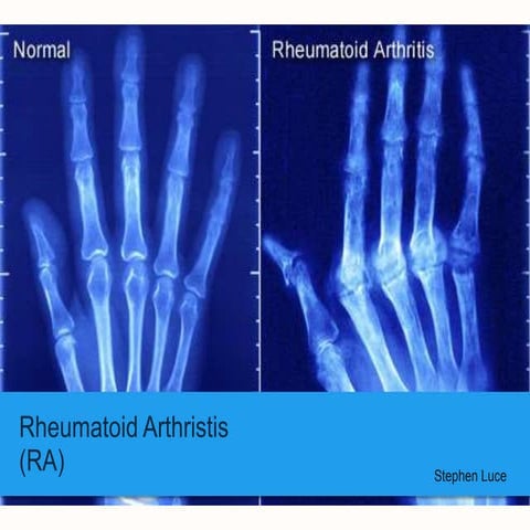 Rheumatoid Arthritis Power Point | PPTX