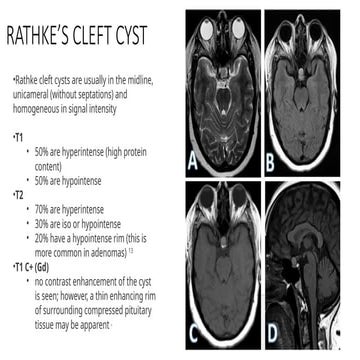 RATHKE’S CLEFT CYST QUESTION NEUROLOGY AND NEUROSURGERY | PPTX ...