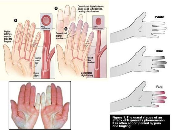 Origin of Raynaud' Syndrome Disease and The Nitric Oxide Solution | PPT