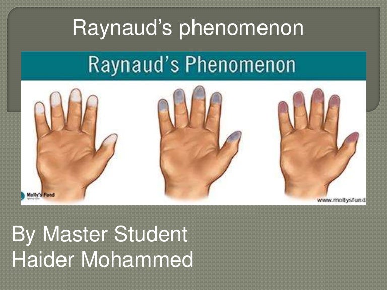 Raynaud’s phenomenon