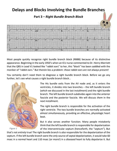 Right bundle branch block | PPT