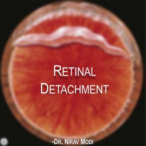Retinal detachment presentation | PPTX