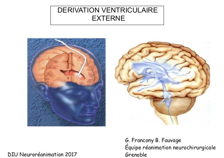 derivation ventriculaire externe dve n rea_2017