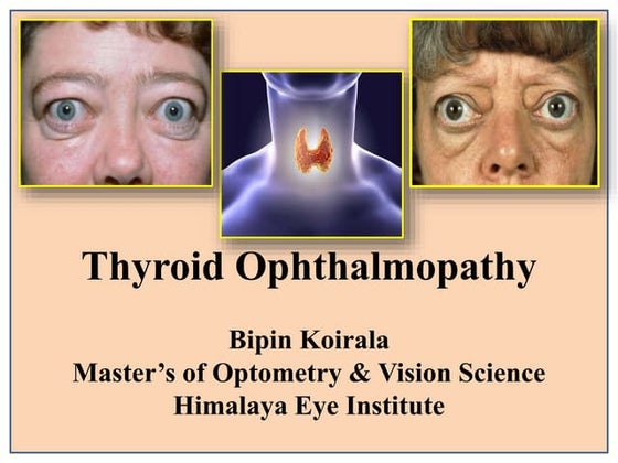 THYROID OPHTHALMOPATHY.ppt