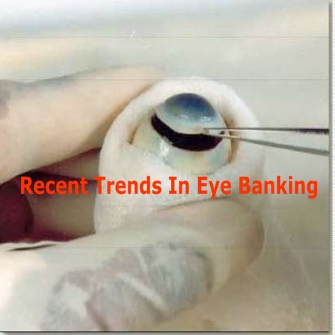 Recent trends in eye banking | PPT