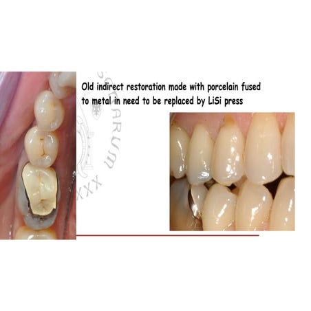 Replacement of old PFM partial crown with LiSi press onlay | PDF | Oral ...