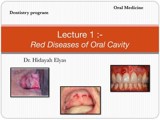 Red Lesions in oral cavity oral medicine | PPT