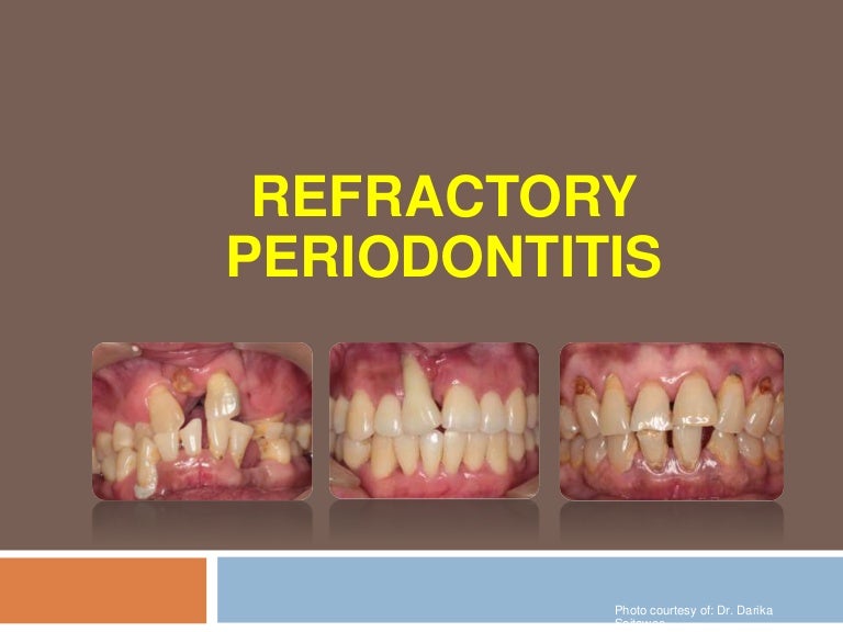 Refractory periodontitis