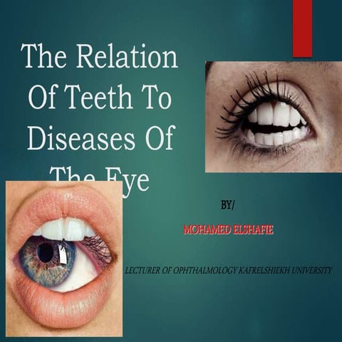 Relation between teeth and diseases of eye | PPT