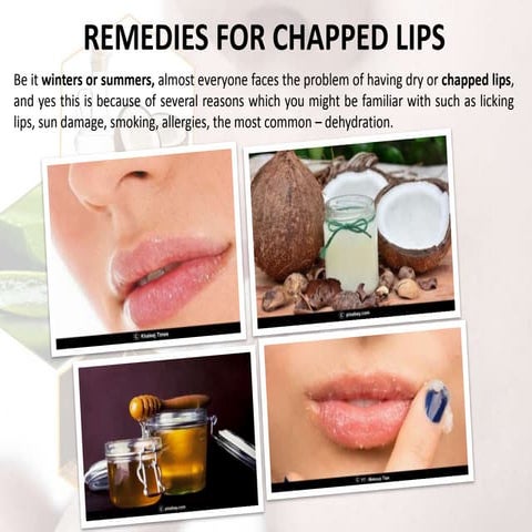 Remedies for chapped lips | PPTX