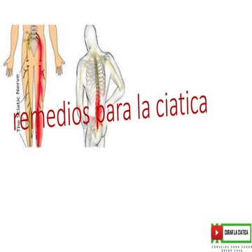 Sintomas de la ciatica | PPTX
