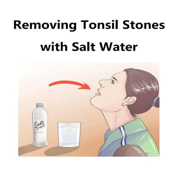 Removing tonsil stones with salt water | PDF