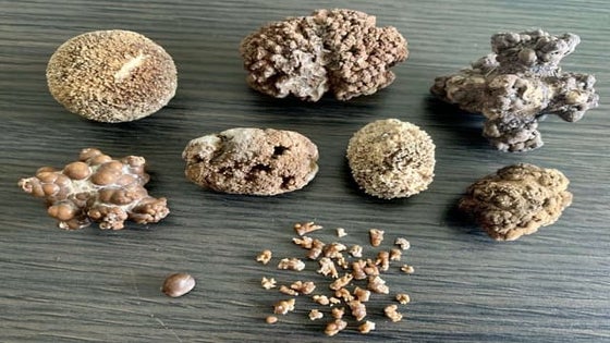 Renal calculi | PPTX