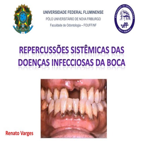 Repercussões sistêmicas das doenças infecciosas da boca | PPTX