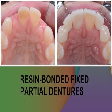 Posterior Resin Bonded Retainers Single‐retainer All‐ceramic