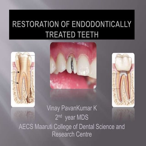 Cast post - Restoration of endodontically treated teeth | PPTX