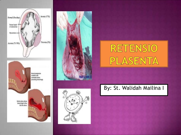 Retensio plasenta