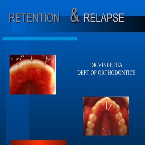 RETENTION AND RELAPSES - DR VINEETHA.ppt