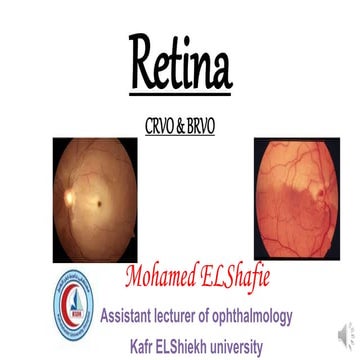 Retina Central Retinal Vein Occlusion | PPTX