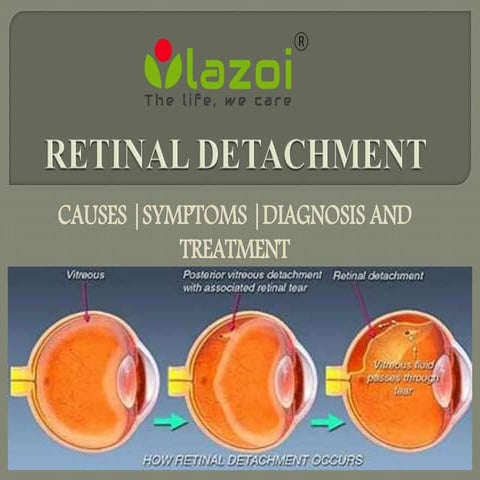 Retinal detachment : Causes, symptoms and treatment | PPT