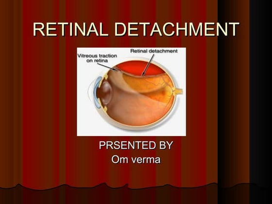 Retinal detachment | PPT