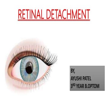 Retinal detachment | PPTX