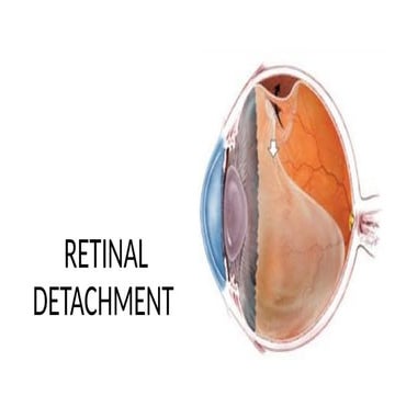Retinal detachment and it's management | PPTX