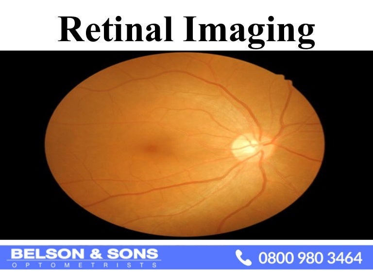 Retinal imaging