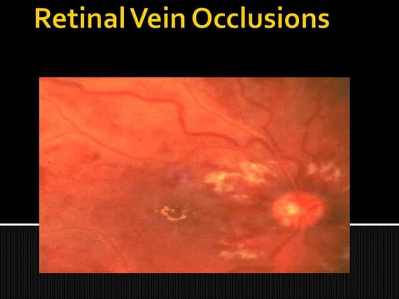 rvo.ppt retinal vein occlusion reti00nal | PPT