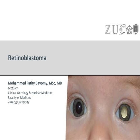 Retinoblastoma | PPT