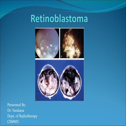 Retinoblastoma dr vandana | PPT