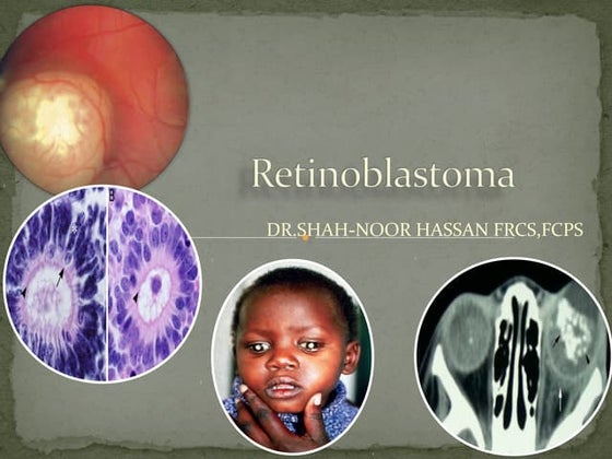 Retinoblastoma | PDF