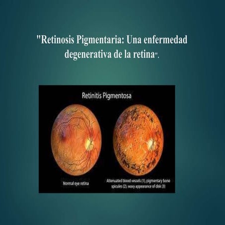 Retinosis Pigmentaria (2).pptx