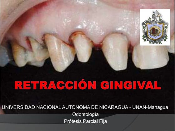 Clasificaciín de Black y Caso clínico | PDF | Dental Health | Diseases ...