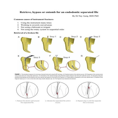Retrieve, bypass or entomb for an endodontic separated file | PDF