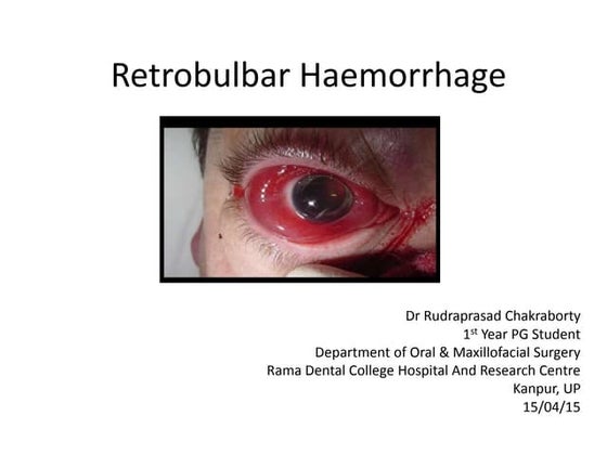 Orbital Hemorrhage Following Trivial Trauma | PPT