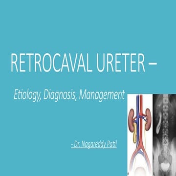RETROCAVAL URETER Urology lecture final. | PPTX