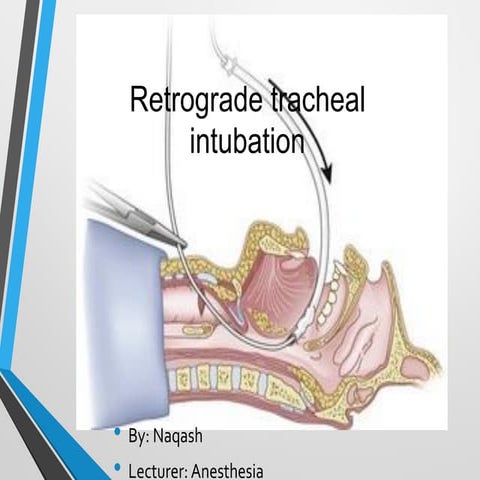 Retrograde Intubation Difficult Intubation Pdf