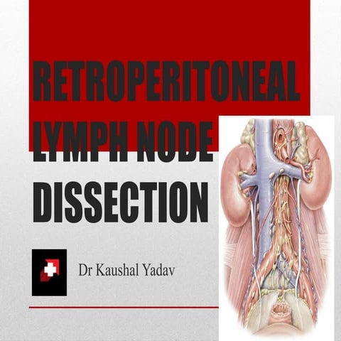 Retroperitoneal lymph node dissection kaushal | PPTX