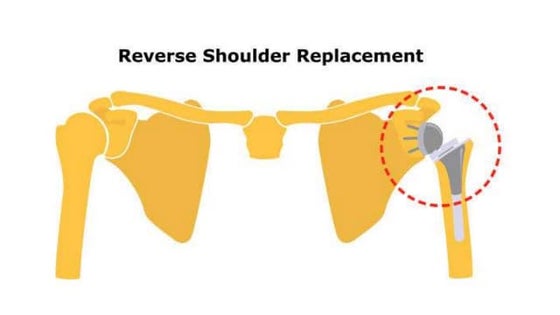 Rotator Cuff Tear Arthroscopy, Rotator Cuff Surgery and Repair by Dr ...