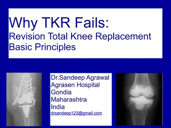 Knee Replacement Revision | PPT