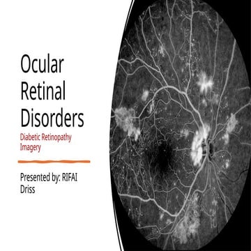 MDA FUNDU OCT OCTA RETINAL DISORDERS OCULAR PPT Rhetino.pptx
