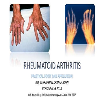 Rheumatoid arthritis | PPT