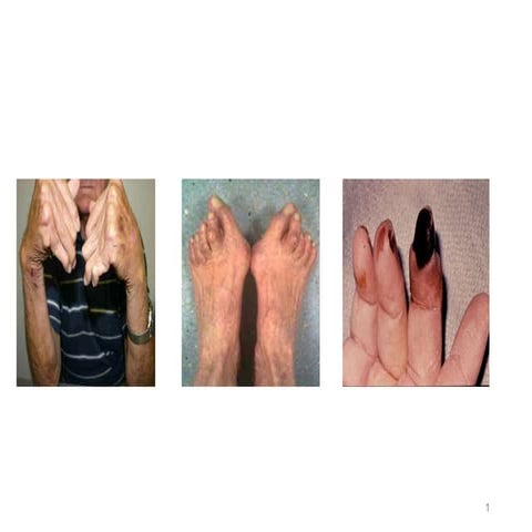 Rheumatoid arthritis and gout.ppt