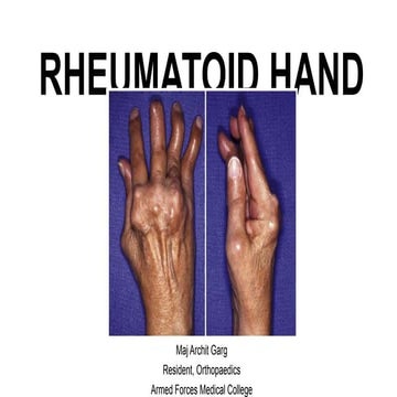 Rheumatoid Arthritis of Hand and wrist.pptx