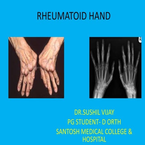 Rheumatoid hands | PPTX