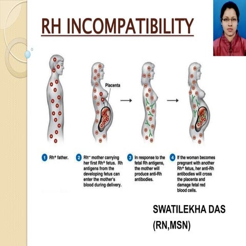 Rh Incompatibility I Hemolytic Disease of the Newborn | PDF