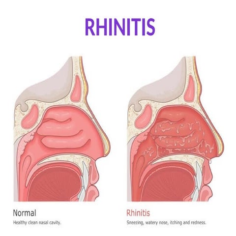 Rhinitis Pptx Nnnnnnnnnnnnnnnnnnnnnnnnnnnnnnnnnnnnnnnnn Pptx Allergies Diseases And Conditions