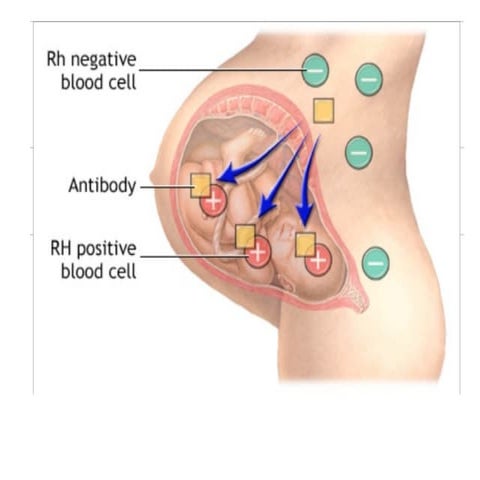 Rh NEGATIVE PREGNANCY or RH incompability.pptx