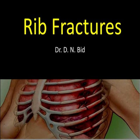 Rib fractures dnbid 2016 | PPTX